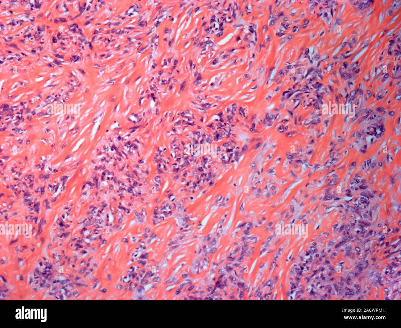 Smooth muscle cancer. Light micrograph of a section through a ...