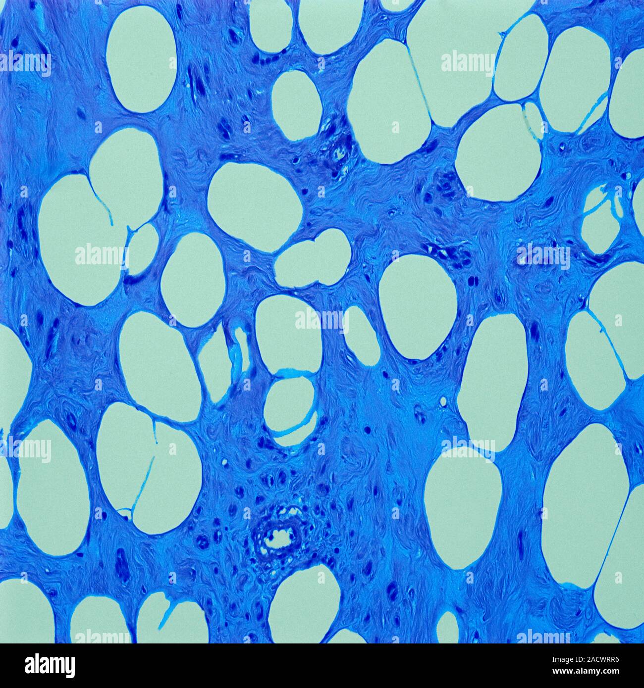 Uterine fibroid. Light micrograph of a section through a lipoleiomyoma ...
