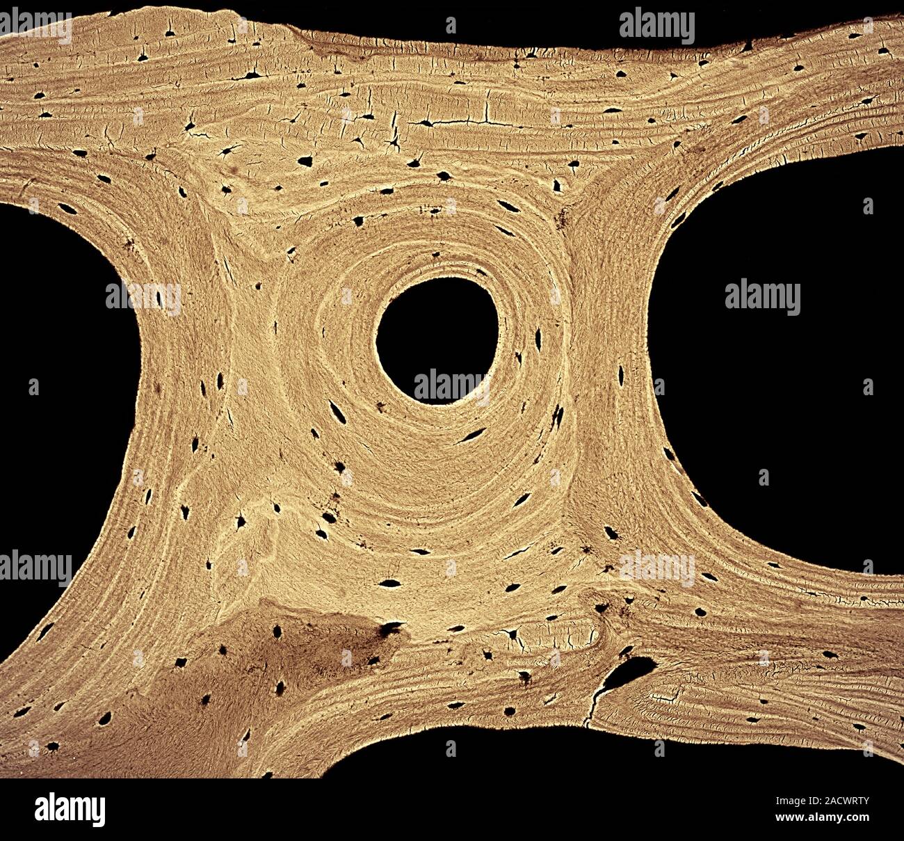 False Coloured Scanning Electron Micrograph Of A Cross Section Through Cancellous Bone