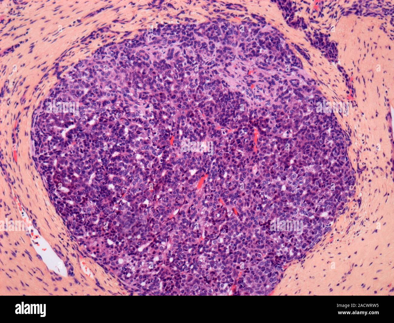 Liver cancer. Light micrograph of a section through a hepatoblastoma, a ...
