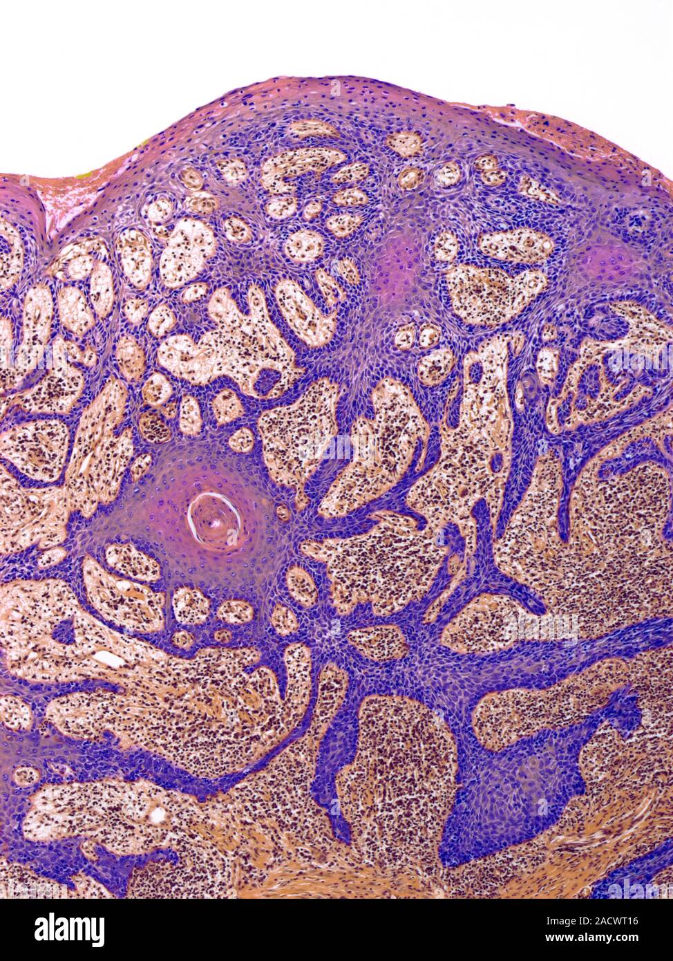 Mouth cancer. Light micrograph of a section through a squamous cell ...