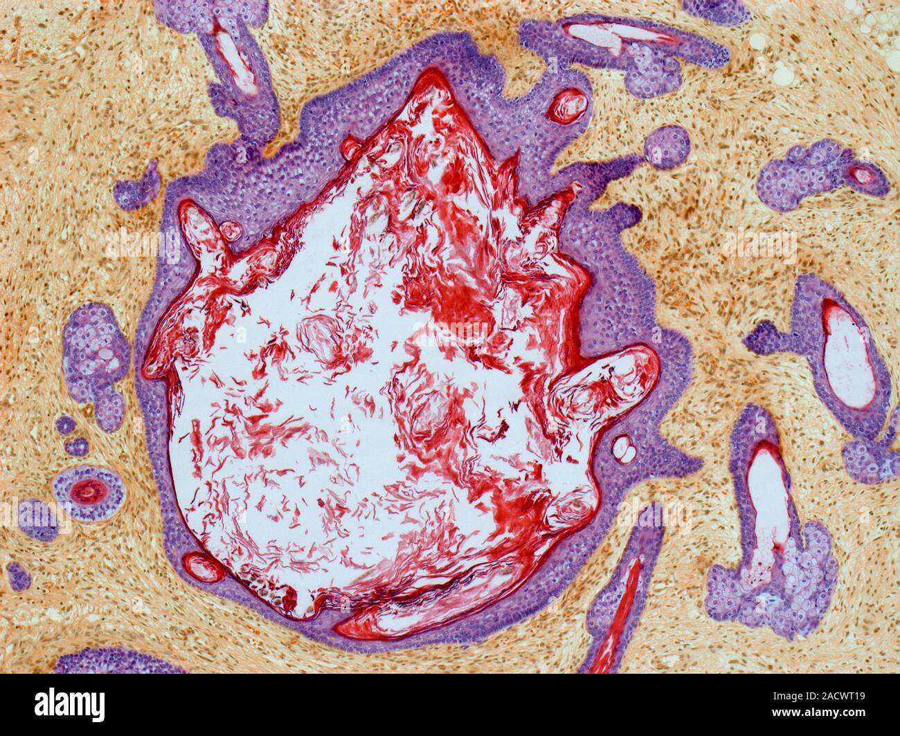 Dermoid Ovarian Cyst Light Micrograph Of A Section Through An Ovary Showing A Dermoid Or