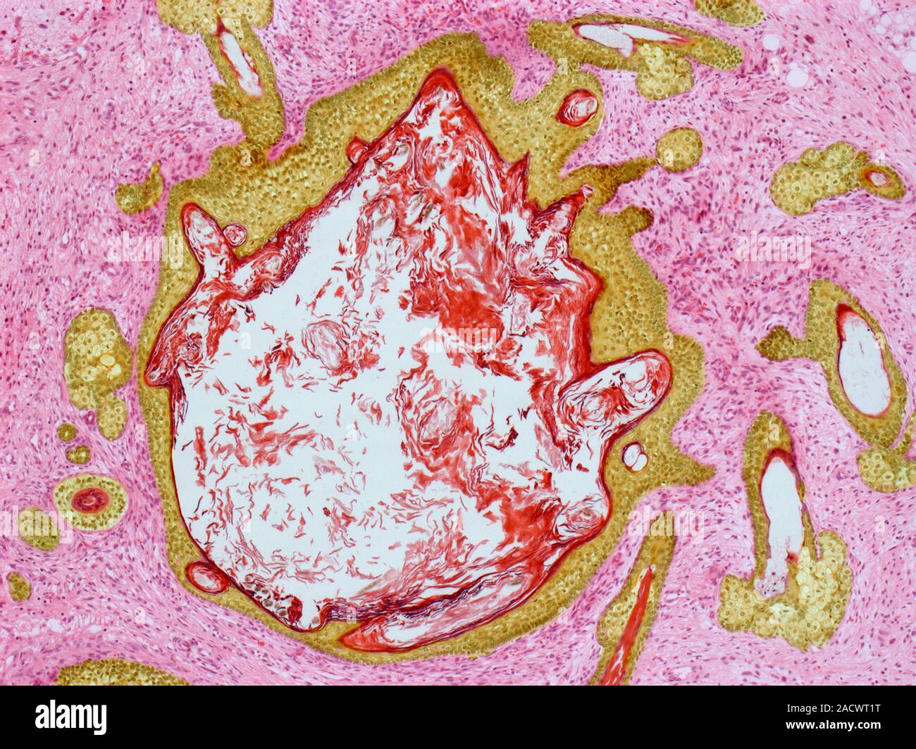 Dermoid Ovarian Cyst Light Micrograph Of A Section Through An Ovary Showing A Dermoid Or