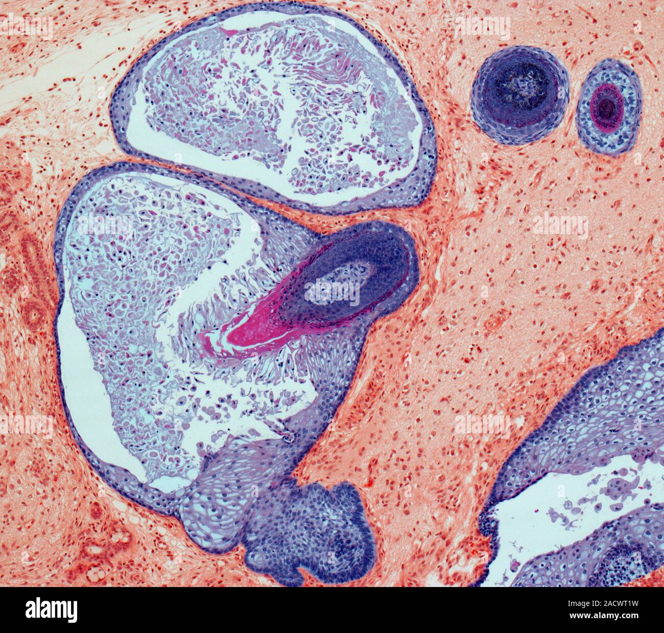 Dermoid ovarian cyst. Light micrograph of a section through an ovary ...