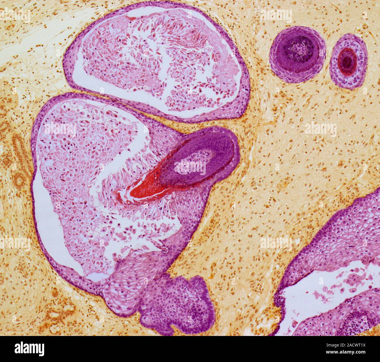 Dermoid ovarian cyst. Light micrograph of a section through an ovary ...