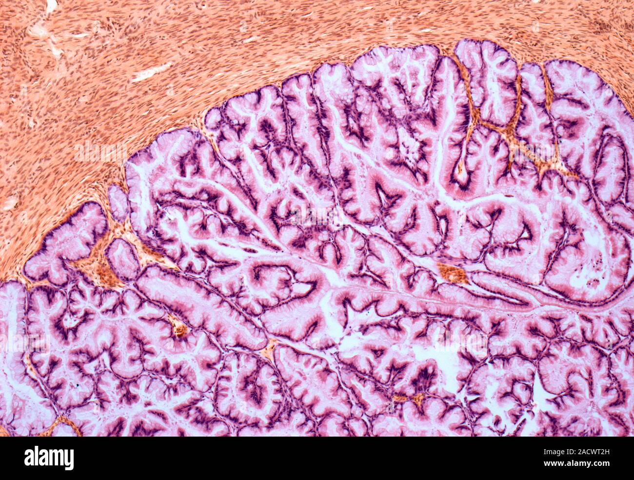 Ovarian tumour,. Light micrograph of a section through a mucinous ...