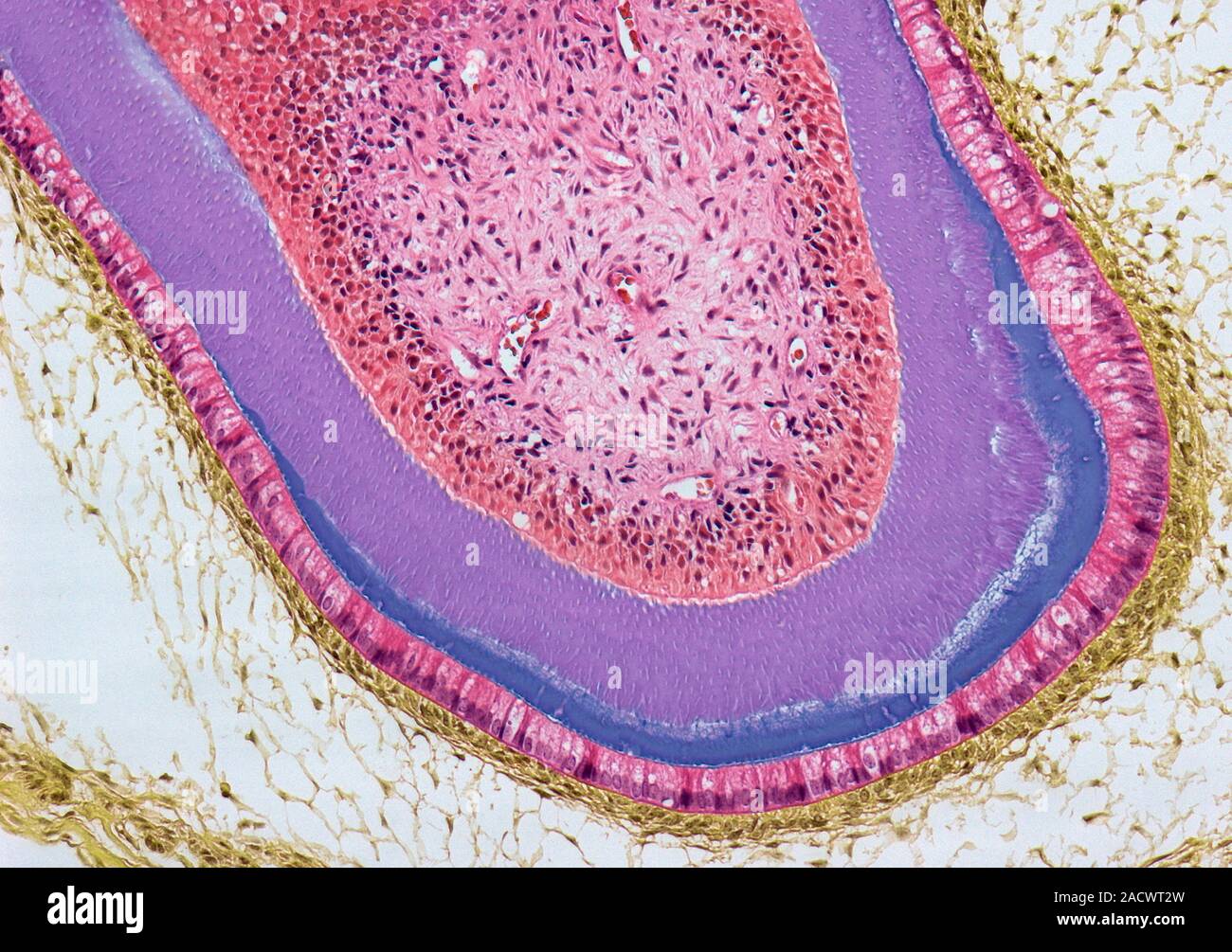 Dermoid Ovarian Cyst Light Micrograph Of A Section Through A Tooth In A Dermoid Or Teratoma