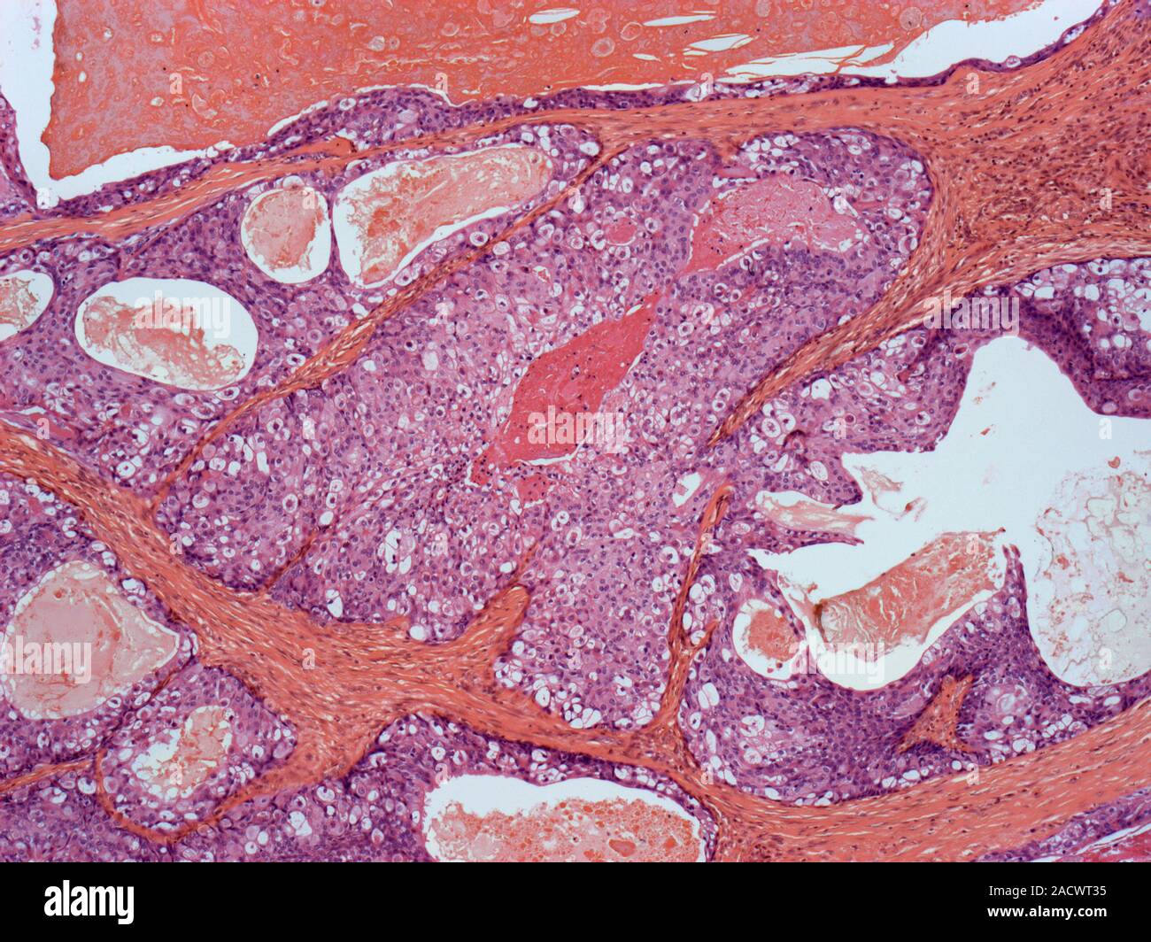 Salivary gland cancer. Light micrograph of a section through a salivary ...