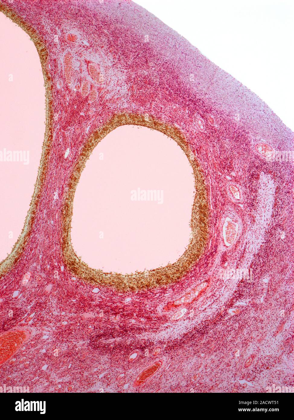 Ovarian cysts. Light micrograph of a section through an ovary with ...