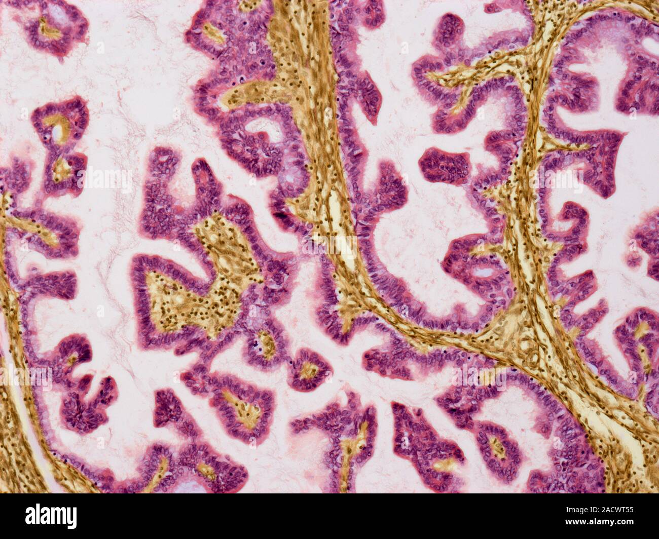 Prostate Hyperplasia Coloured Light Micrograph Of A Section Through A