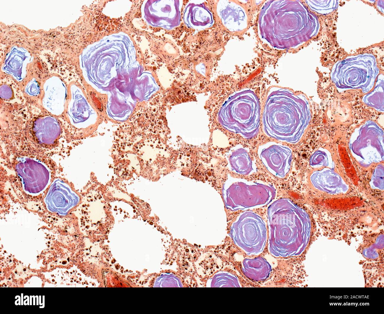 Calcified lung tissue. Light micrograph of a section through lung ...
