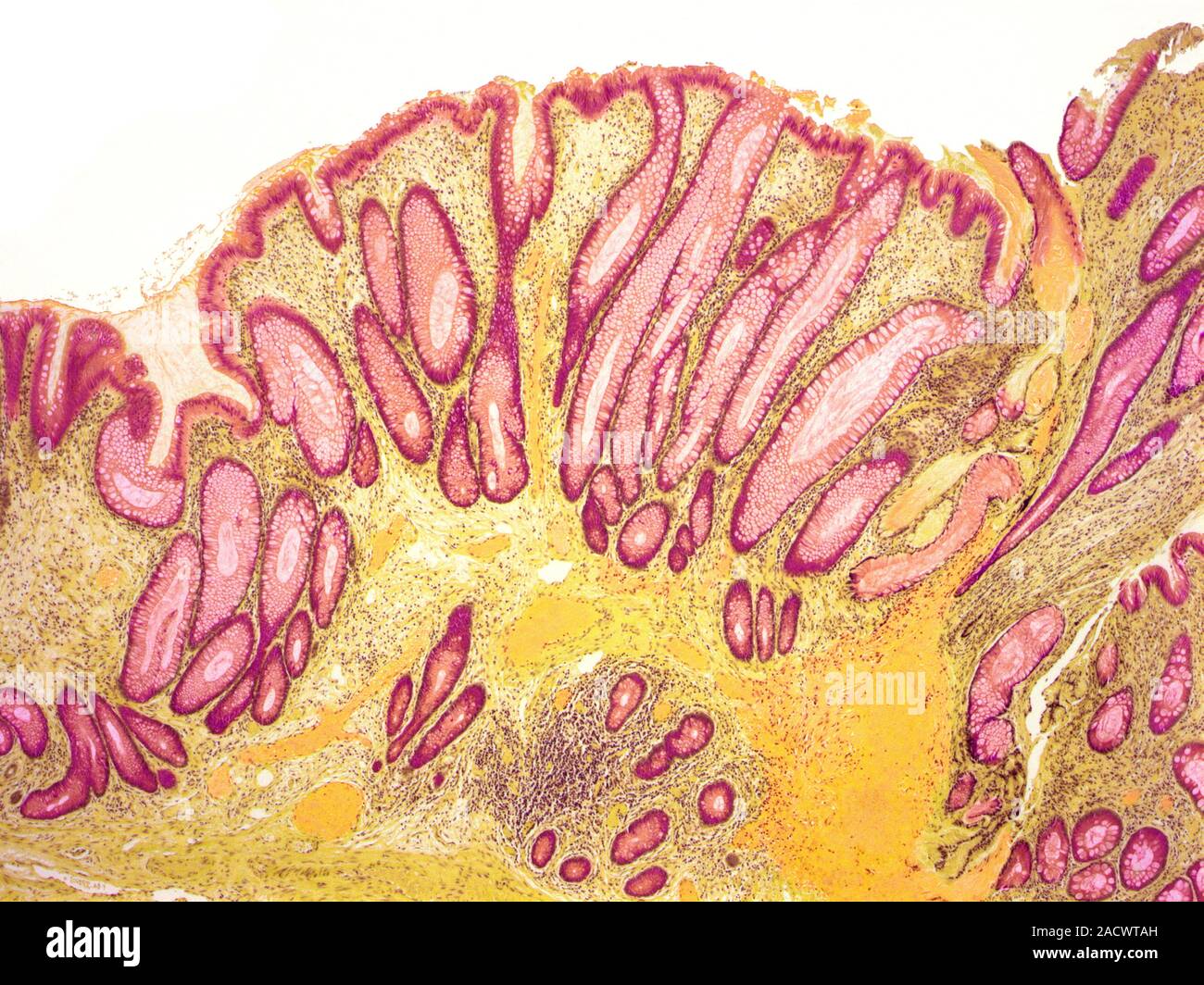 Colorectal polyp. Light micrograph of a section through a colorectal ...