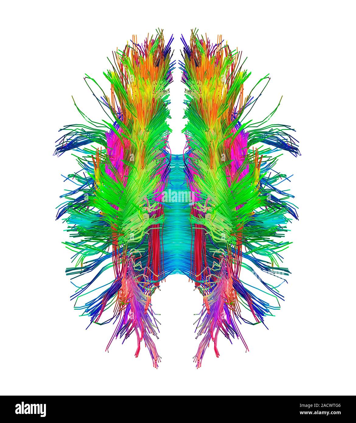 White matter fibres. Coloured 3D diffusion spectral imaging (DSI) scan ...