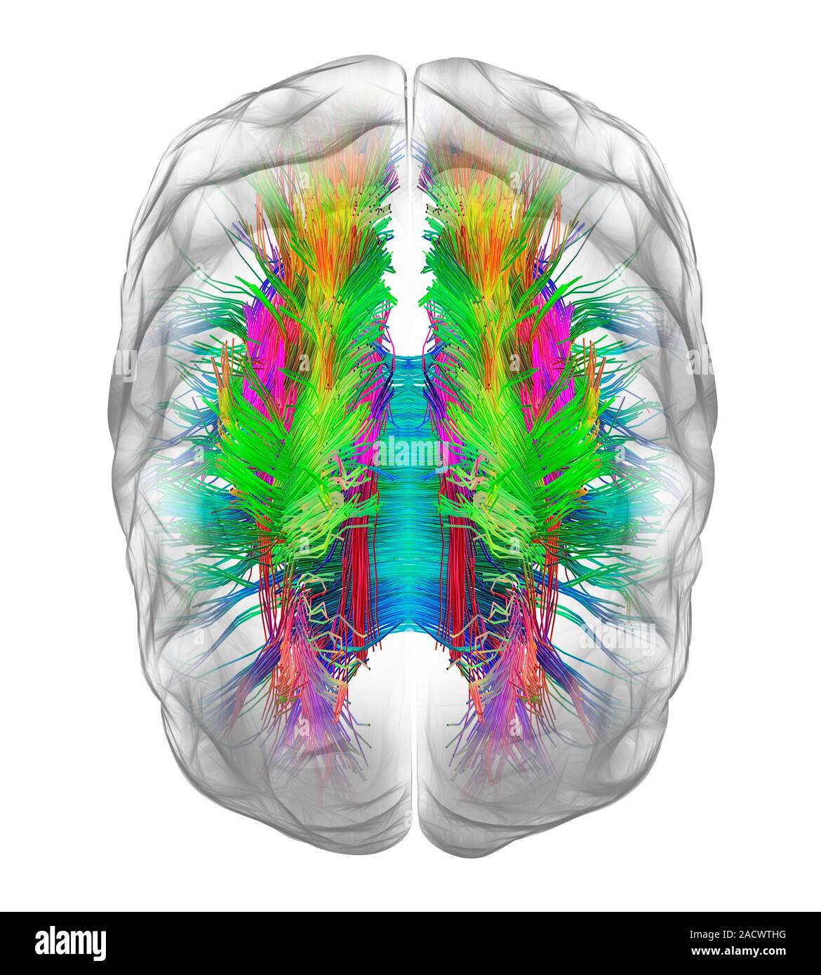 White matter fibres overlaid a 3d model of the human brain in top view. Coloured 3D diffusion ...