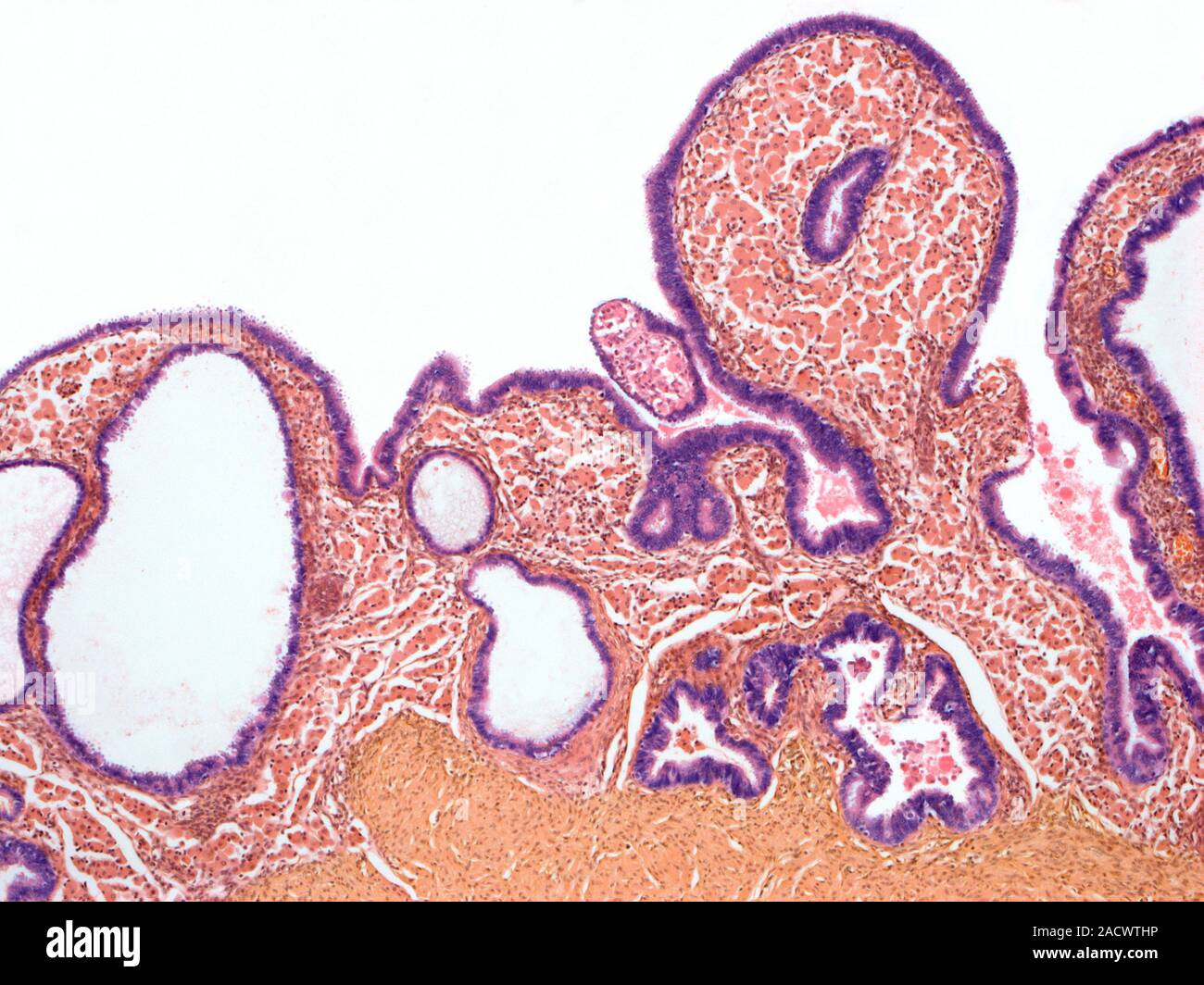 Inflamed fallopian tube. Light micrograph of a section through a ...