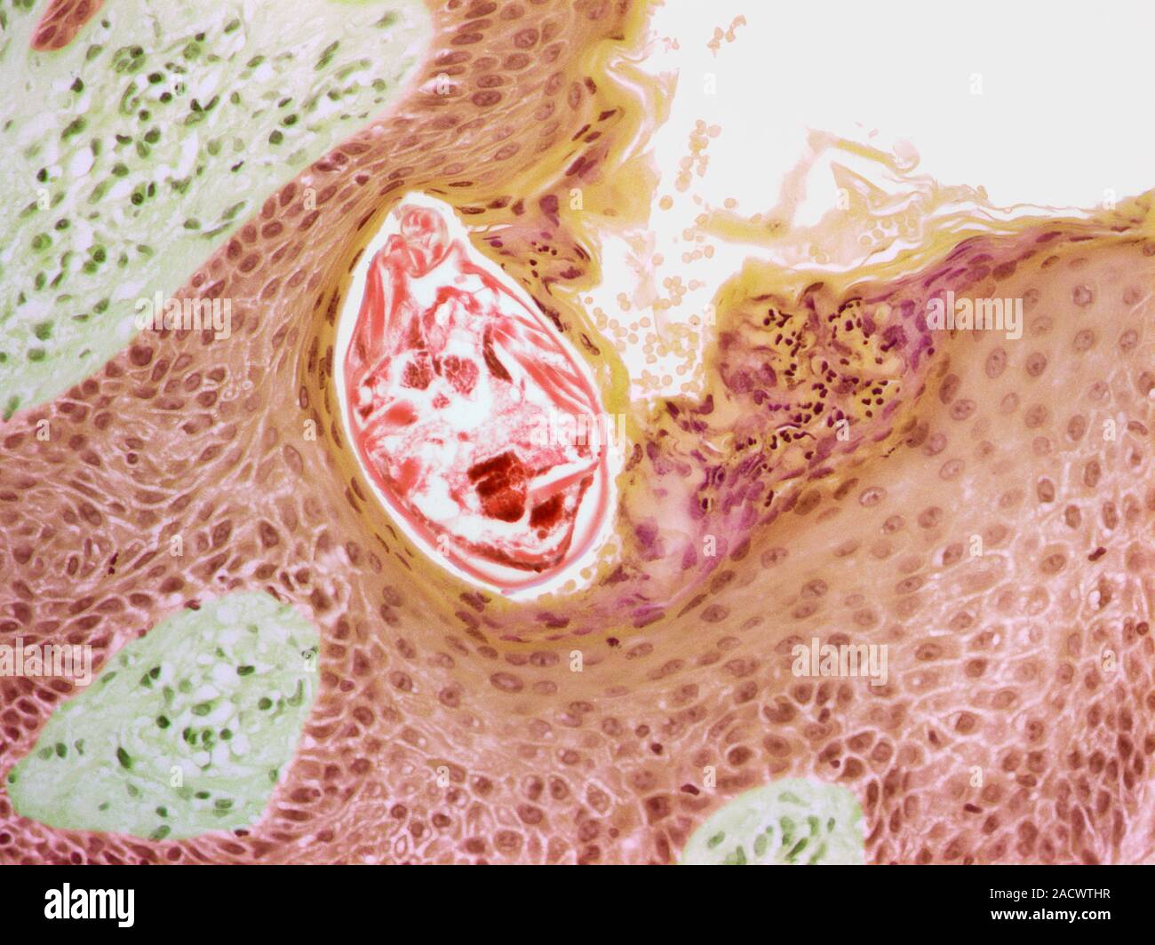 Scabies. Light micrograph of a section through skin showing a scabies ...
