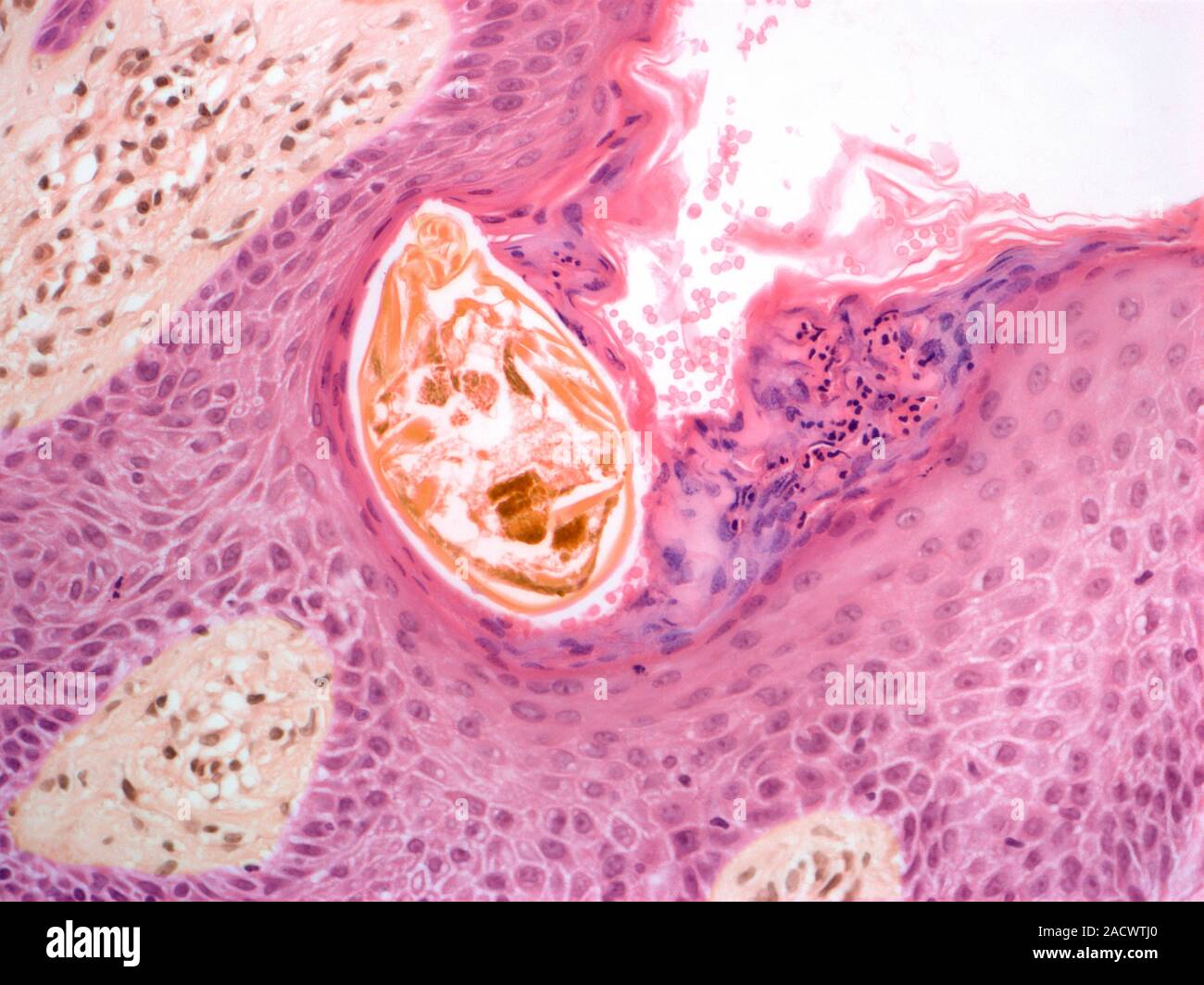 Scabies. Light micrograph of a section through skin showing a scabies ...