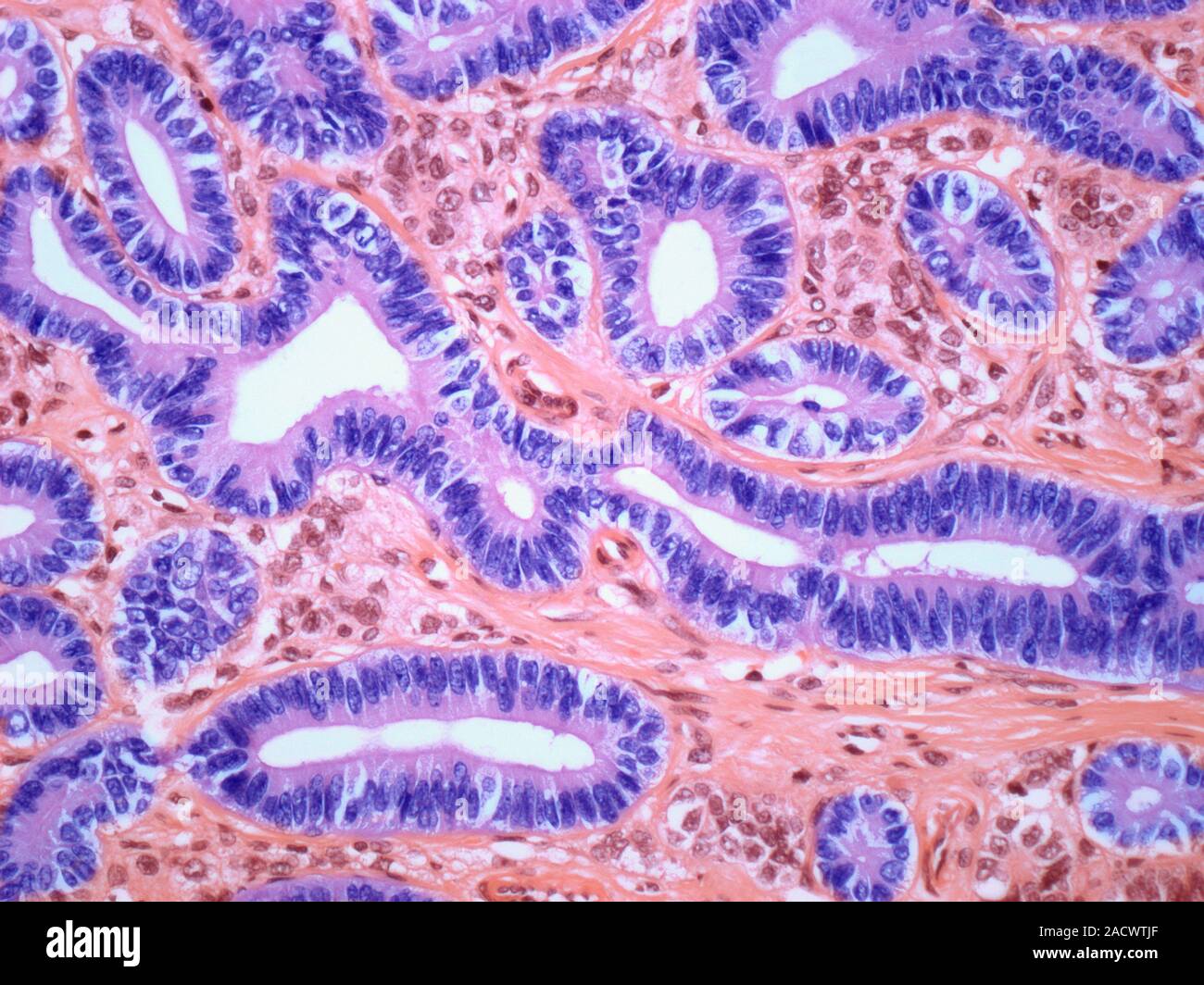 Ovarian Sertoli Leydig Tumour Light Micrograph Of A Section Through A