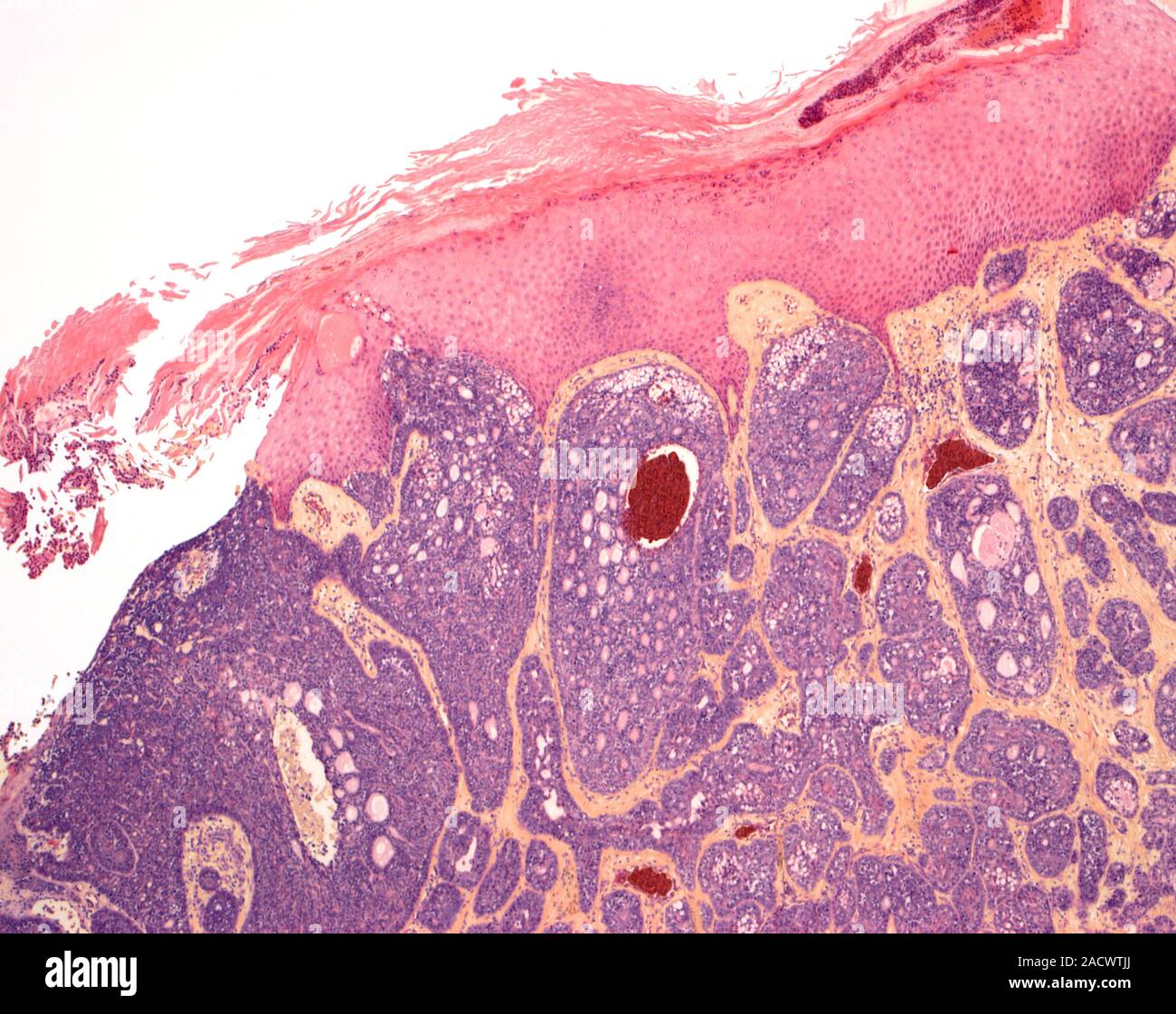 Skin cancer. Light micrograph of a section through a basal cell ...
