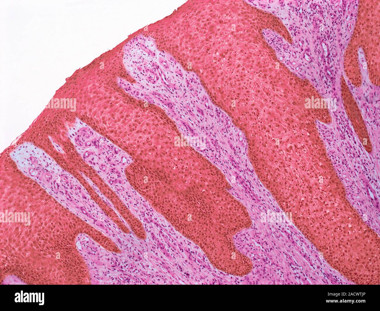 Skin tumour. Light micrograph of a section through a clear cell ...