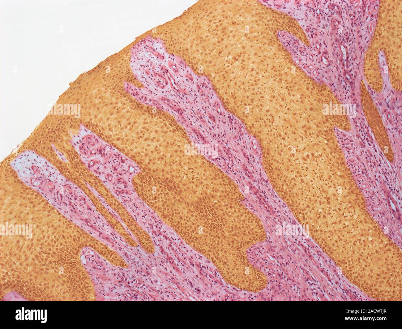 Skin tumour. Light micrograph of a section through a clear cell ...