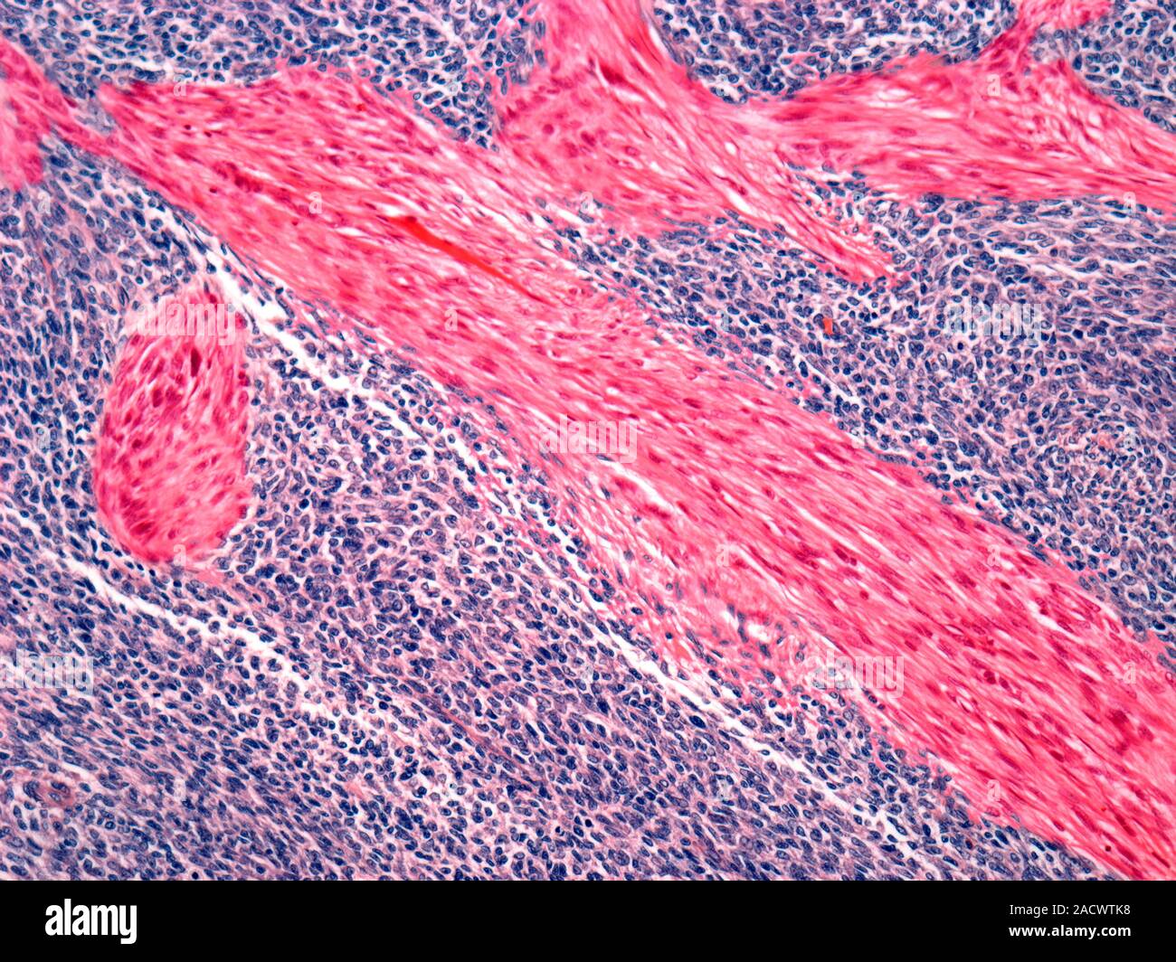 Sarcoma. Light micrograph of a section through a sarcoma (pink ...