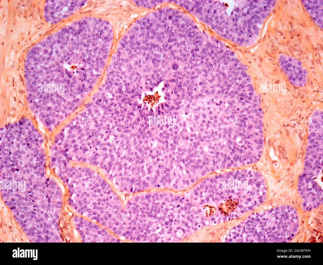 Urinary tract cancer. Light micrograph of a section through a ...