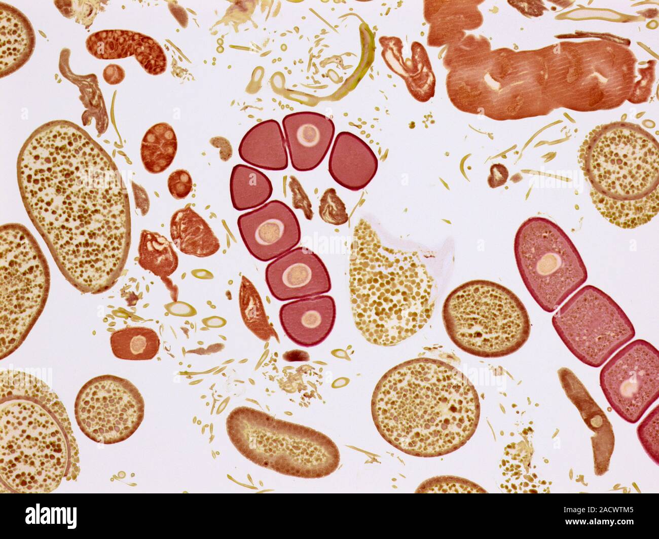 Tungiasis. Light micrograph of a section through tissue infected with ...