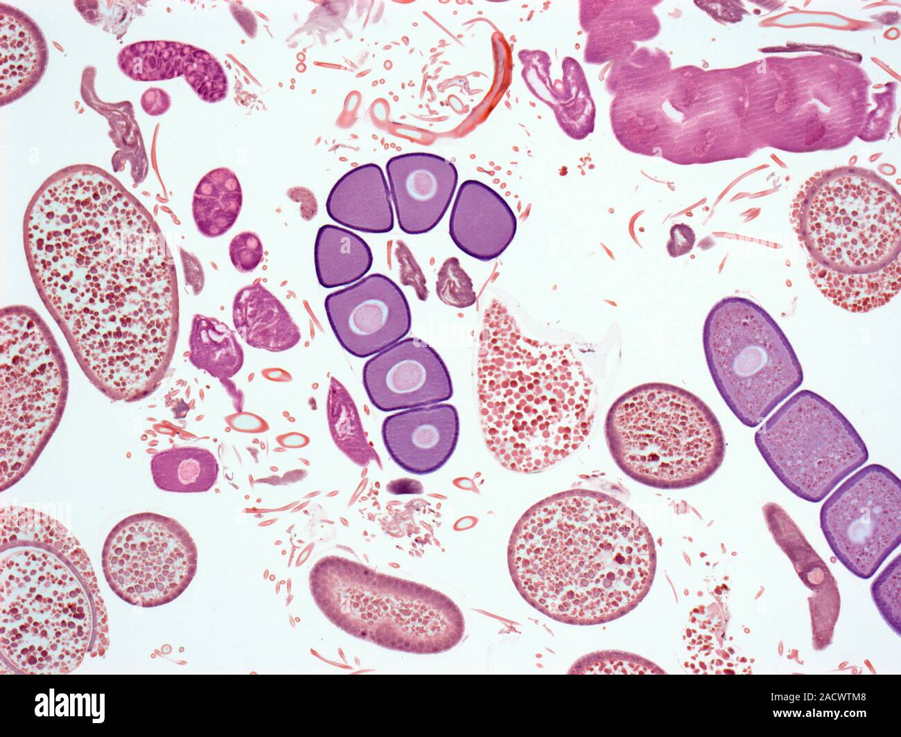Tungiasis. Light micrograph of a section through tissue infected with ...