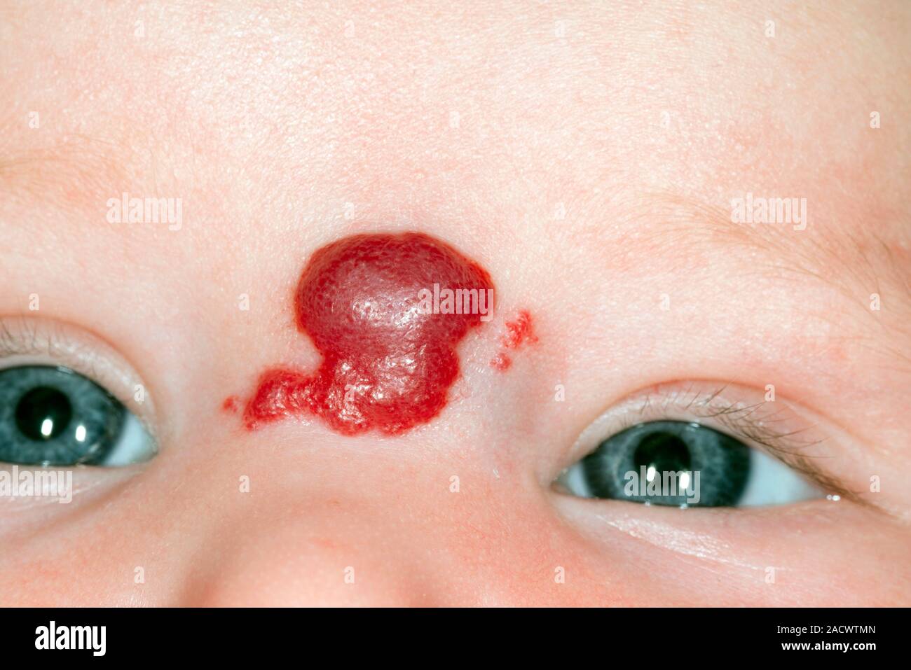 Strawberry naevus. Strawberry naevus (also known as a cavernous ...