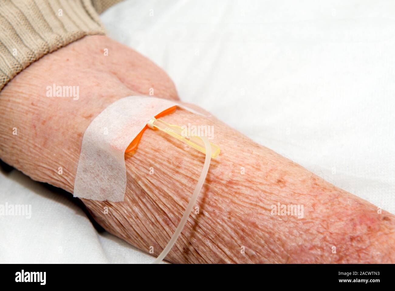 Privigin infusion. Catheter in the arm of a patient receiving a ...