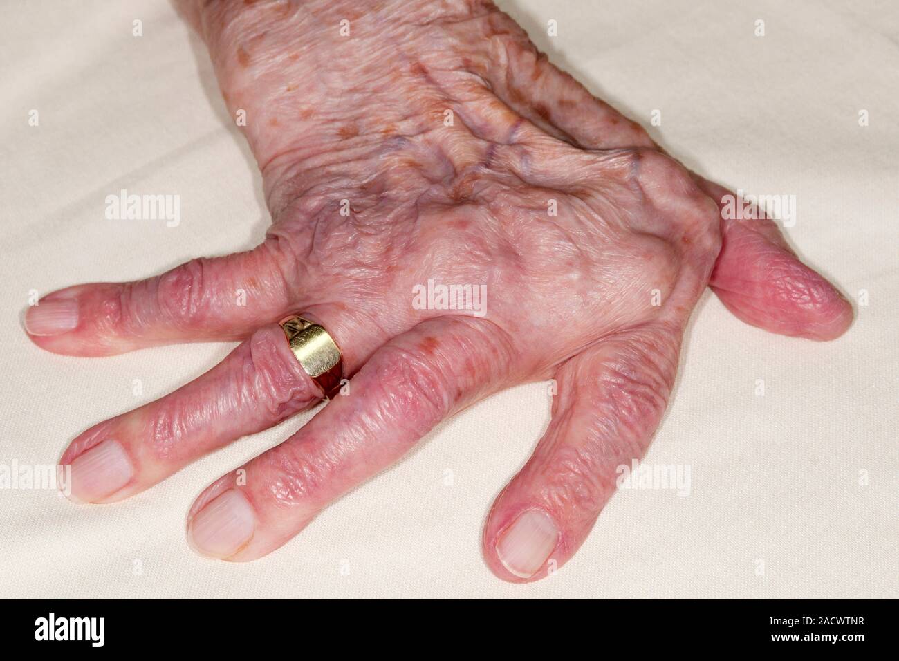 Arthritic hand of a 93 year old female patient with rheumatoid ...