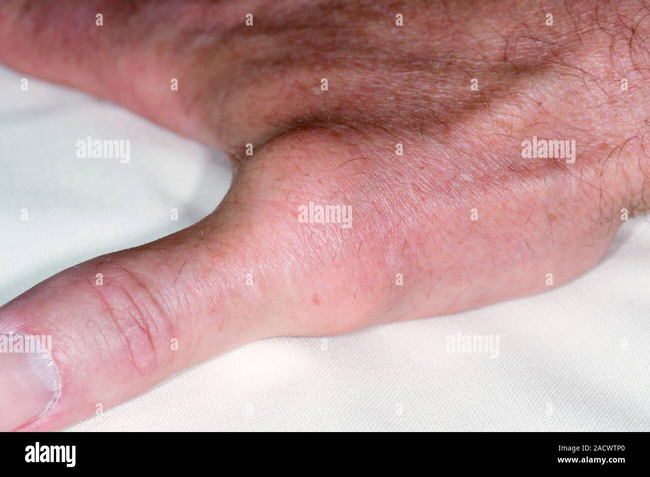 Inflamed thumb joint of a 55 year old male karate player with ...