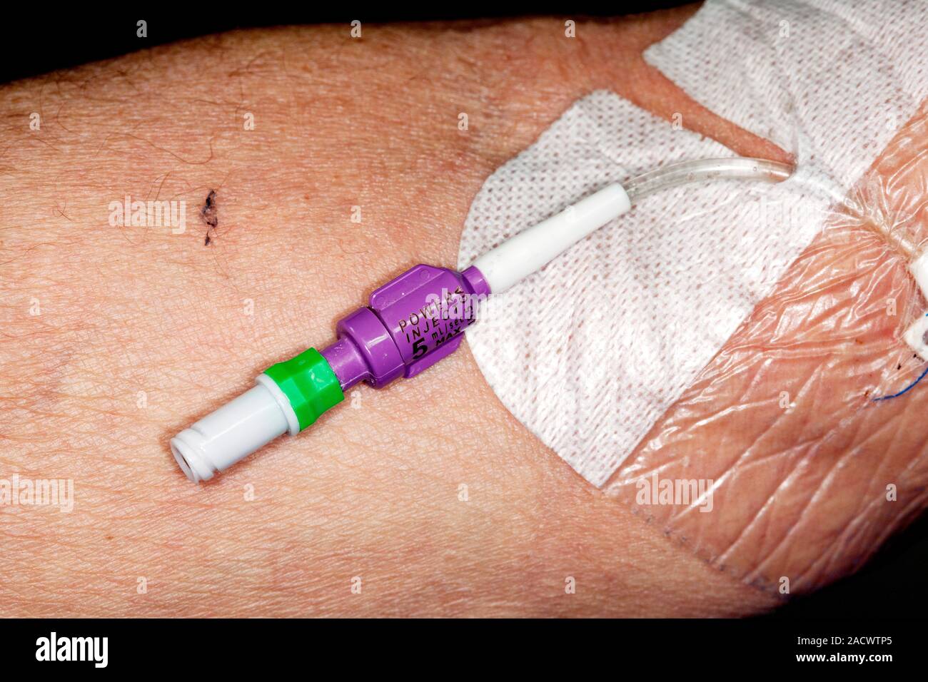 PICC intravenous device. PICC (peripherally inserted central catheter ...