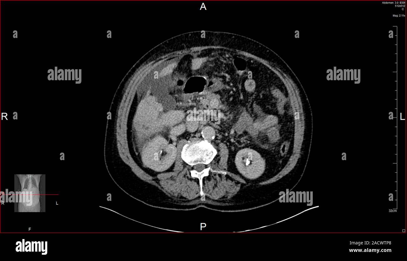 Liver cancer. Computed tomography (CT) scan of the abdomen of an 84 ...