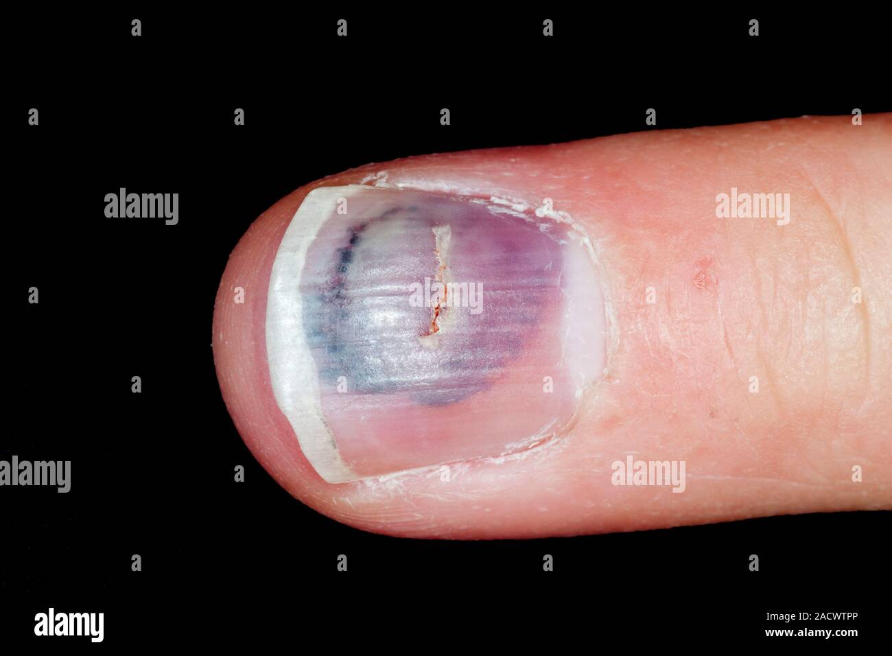 Dog bit on the finger. Fingernail of a 54 year old male patient that ...