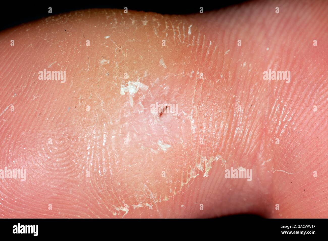 Splinter in the big toe of a 16 year old female patient Stock Photo - Alamy