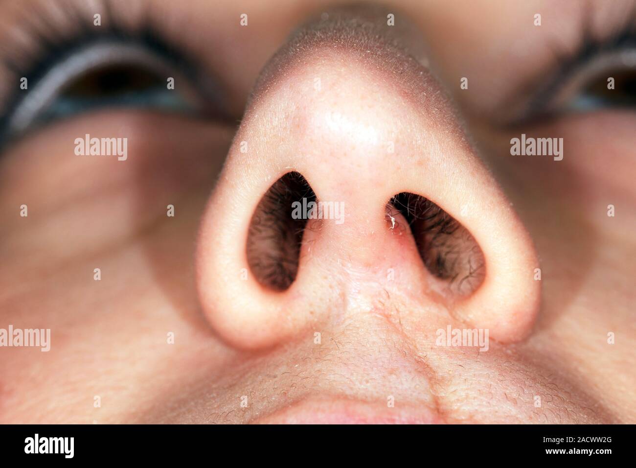 Deviated (crooked) nasal septum of a 35 year old female patient. The ...