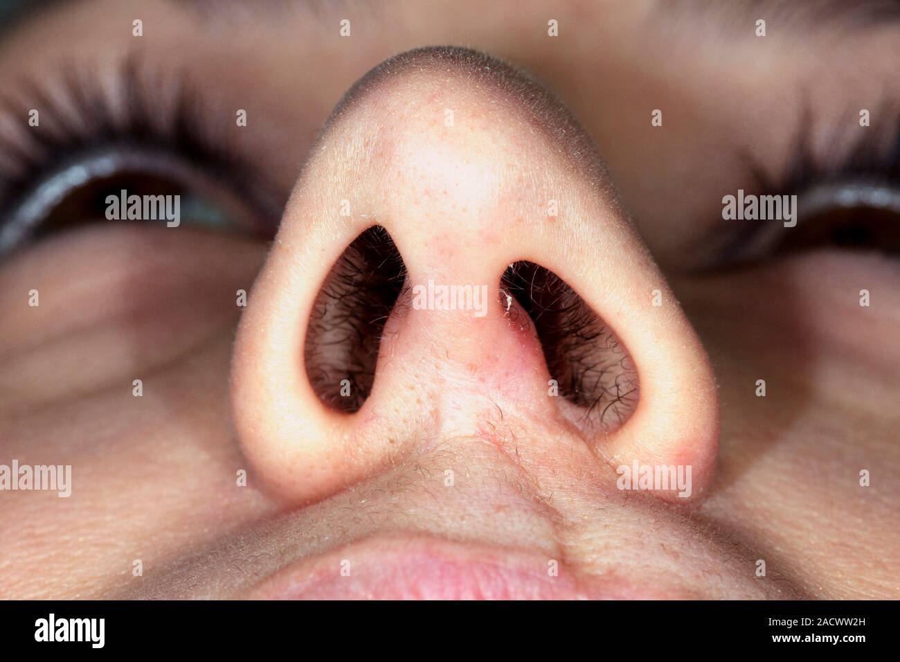 Deviated (crooked) nasal septum of a 35 year old female patient. The ...