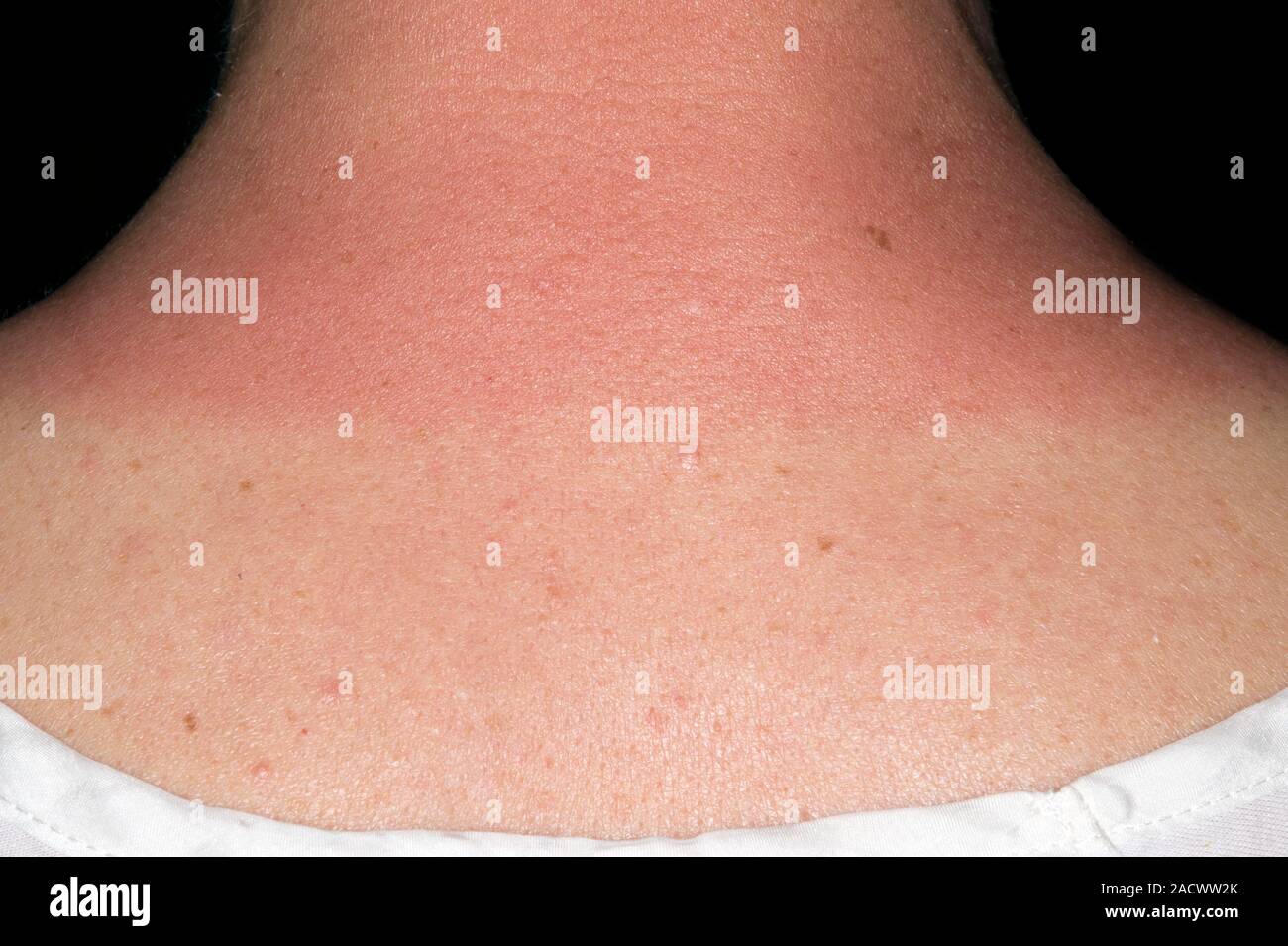 Sunburn on the neck of a 45 year old female patient. Sunburn is caused ...