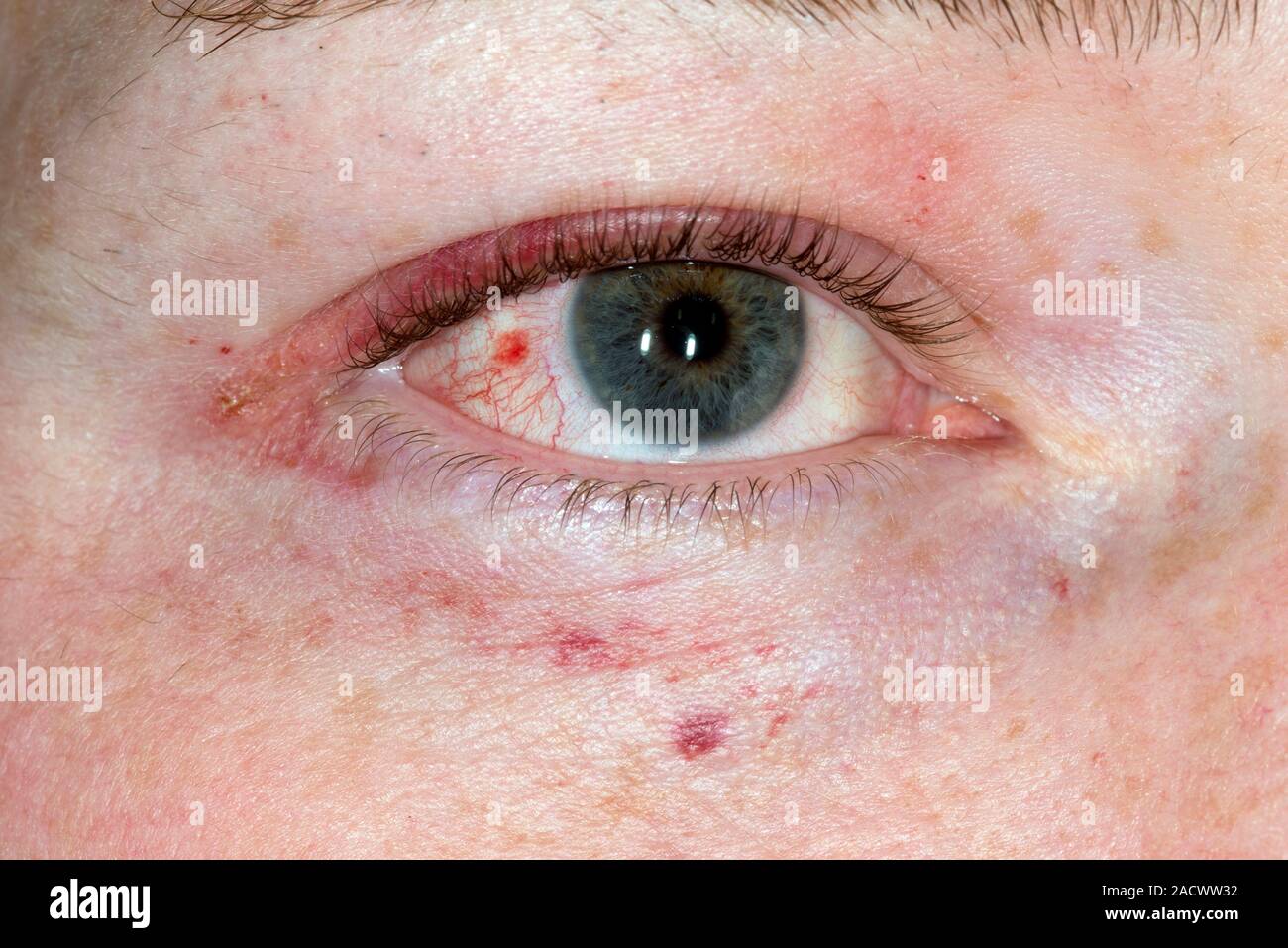 Bruised eye of a 27 year old male patient who was hit in the face by a ...