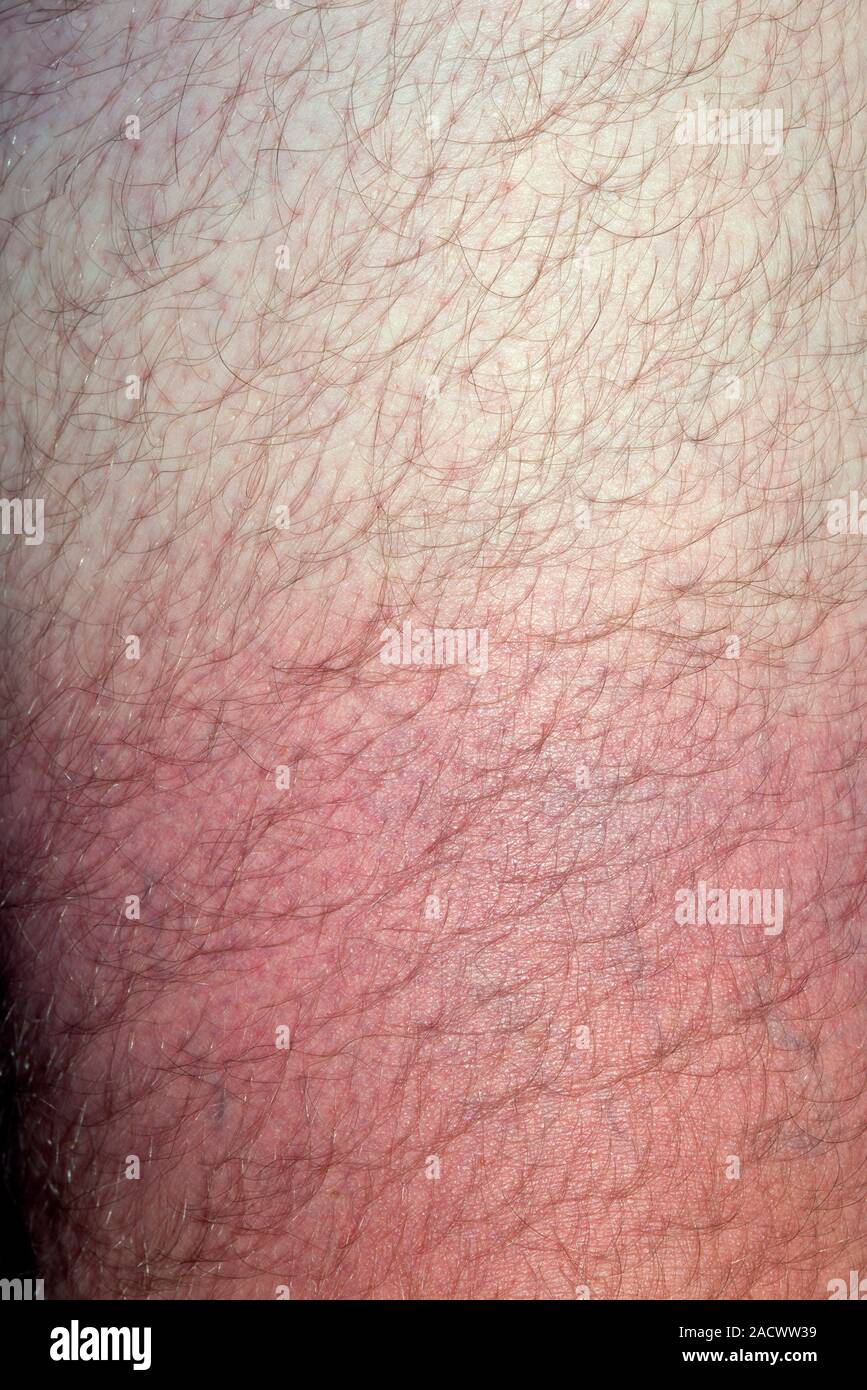 Sunburn on the leg of a 24 year old male patient. Sunburn is caused by ...