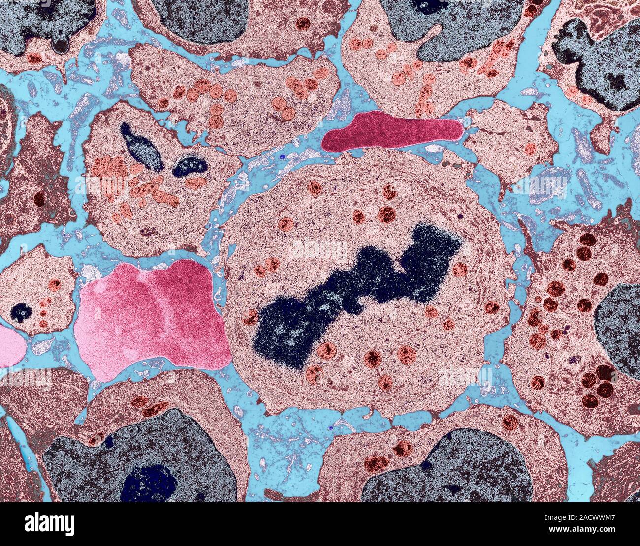 Plasma cell cancer. Coloured transmission electron micrograph (TEM) of ...
