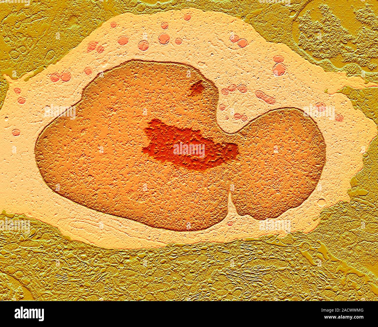 Cancer cell nucleus. Coloured transmission electron micrograph (TEM) of ...