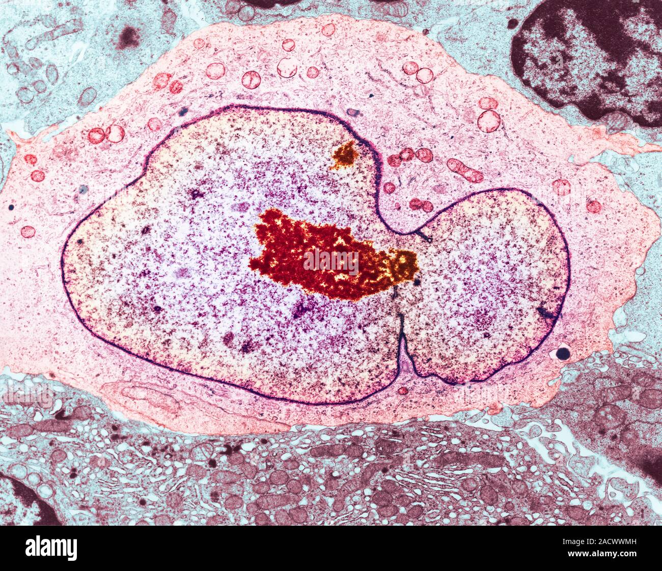 Cancer cell nucleus. Coloured transmission electron micrograph (TEM) of ...