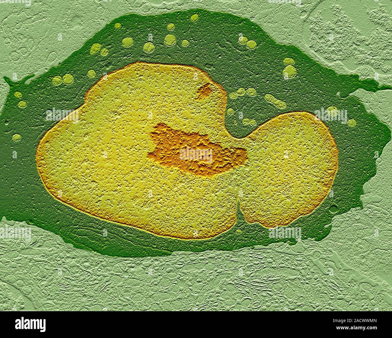 Cancer cell nucleus. Coloured transmission electron micrograph (TEM) of ...