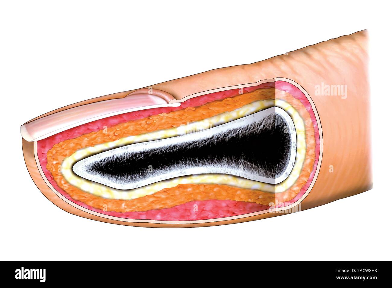 Illustration of fingernail This illustration of distal extremity ...