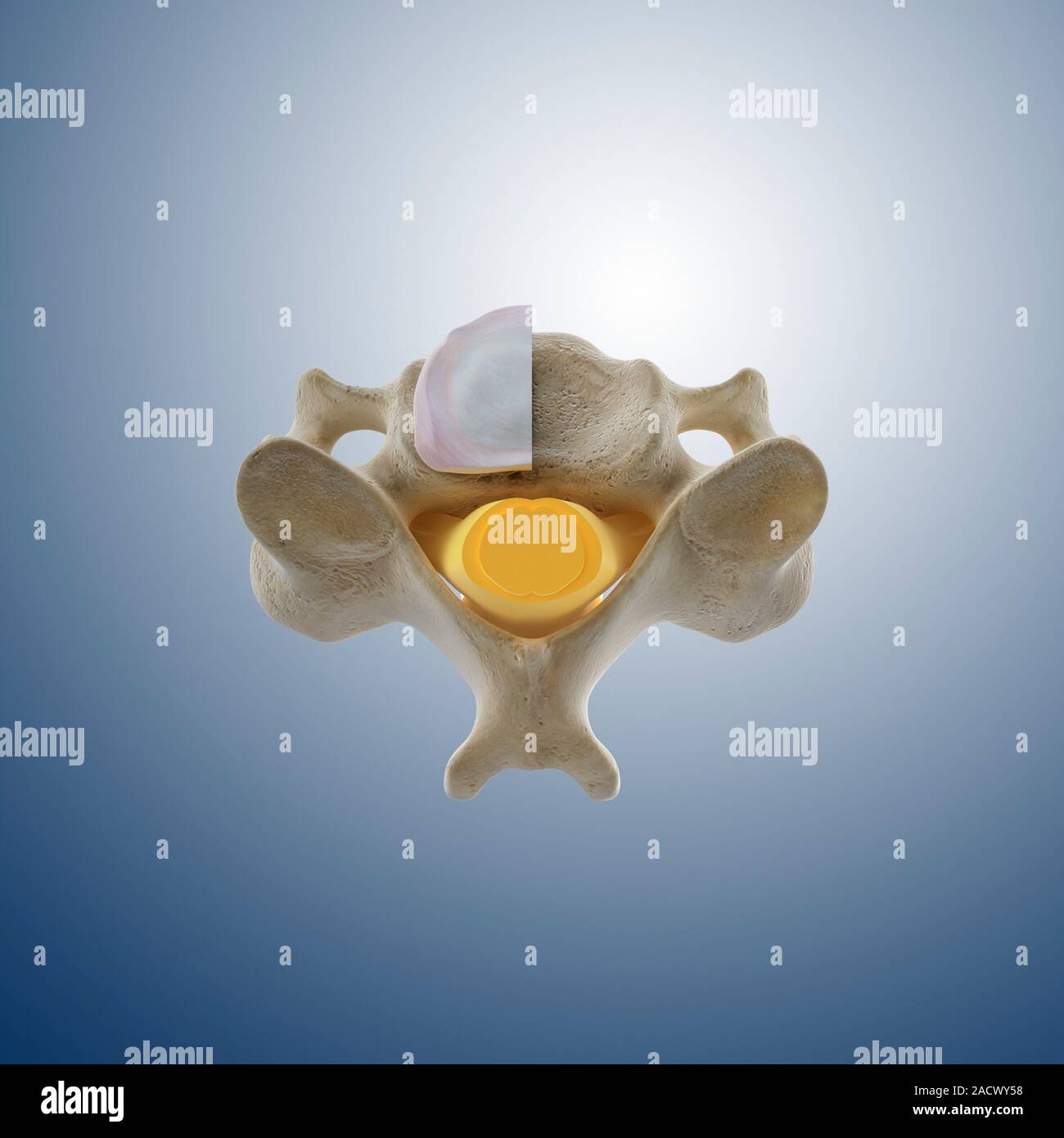 Cervical vertebra (C4). Artwork of one of the cervical vertebrae of the ...