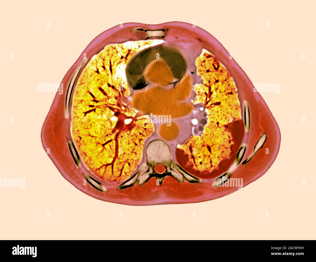 Mesothelioma lung tumour. Coloured axial computed tomography (CT) scan ... Mesothelioma lung tumour. Coloured axial computed tomography (CT) scan ...