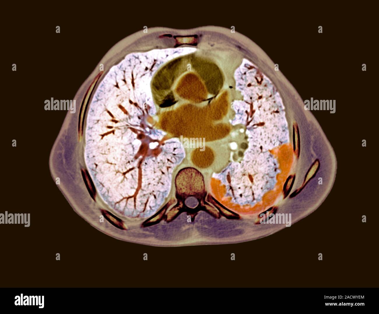 Mesothelioma lung tumour. Coloured axial computed tomography (CT) scan ... Mesothelioma lung tumour. Coloured axial computed tomography (CT) scan ...